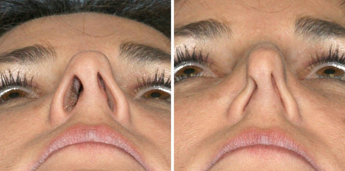 Septal Perforation (Hole in the Nasal Septum) » Prof. Dr. Mustafa Deniz ...