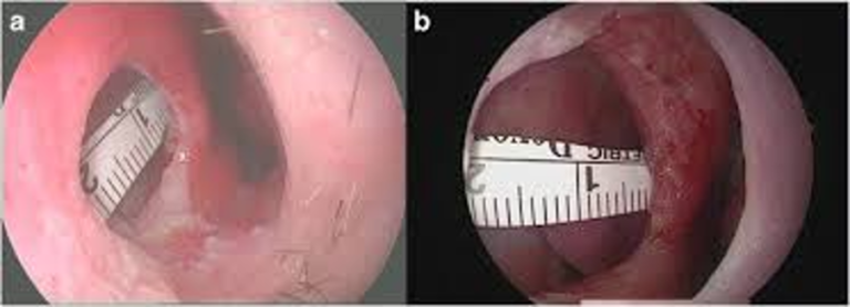 Septal Perforation (Hole in the Nasal Septum) » Prof. Dr. Mustafa Deniz ...